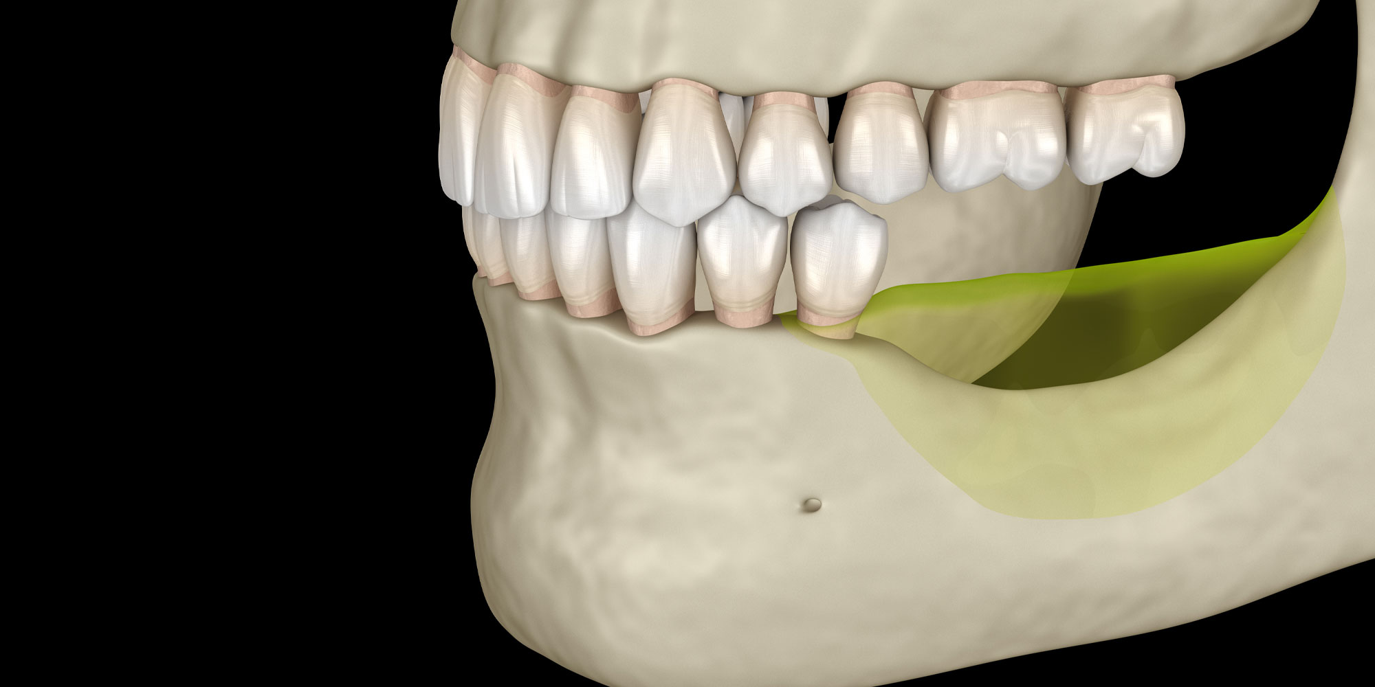 Missing or Failing Teeth | Hendersonville, TN | Tabor Dental
