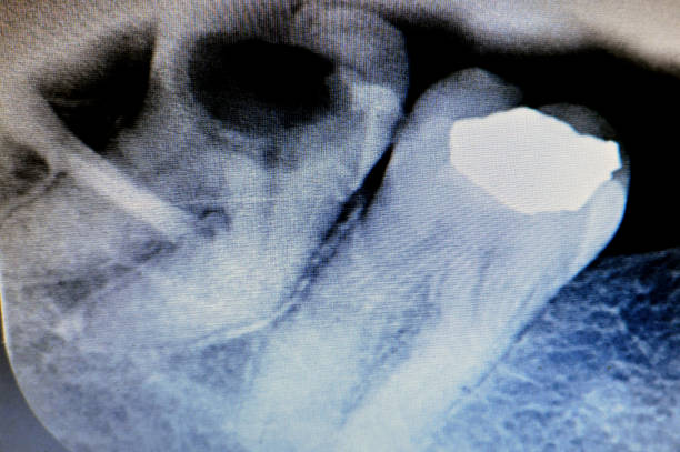 Tooth Roots Exposed | Tabor Dental Associates